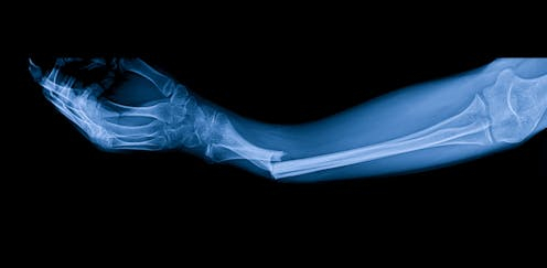 Bone-building drug which prevents fractures in people with osteoporosis ...